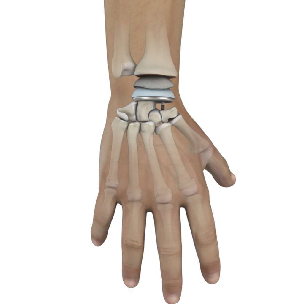 Wrist Procedures - Premier Orthopedic Specialists of Tulsa